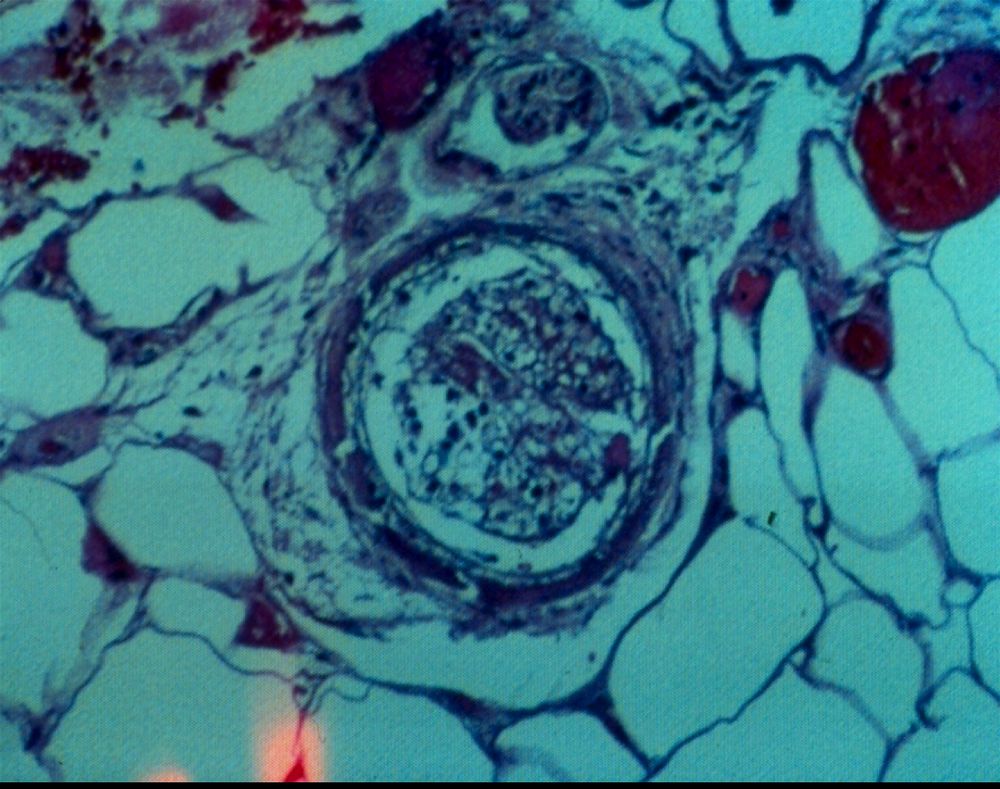 Síndromes de necrosis cutanea: un reto en la consulta del dermatólogo ...