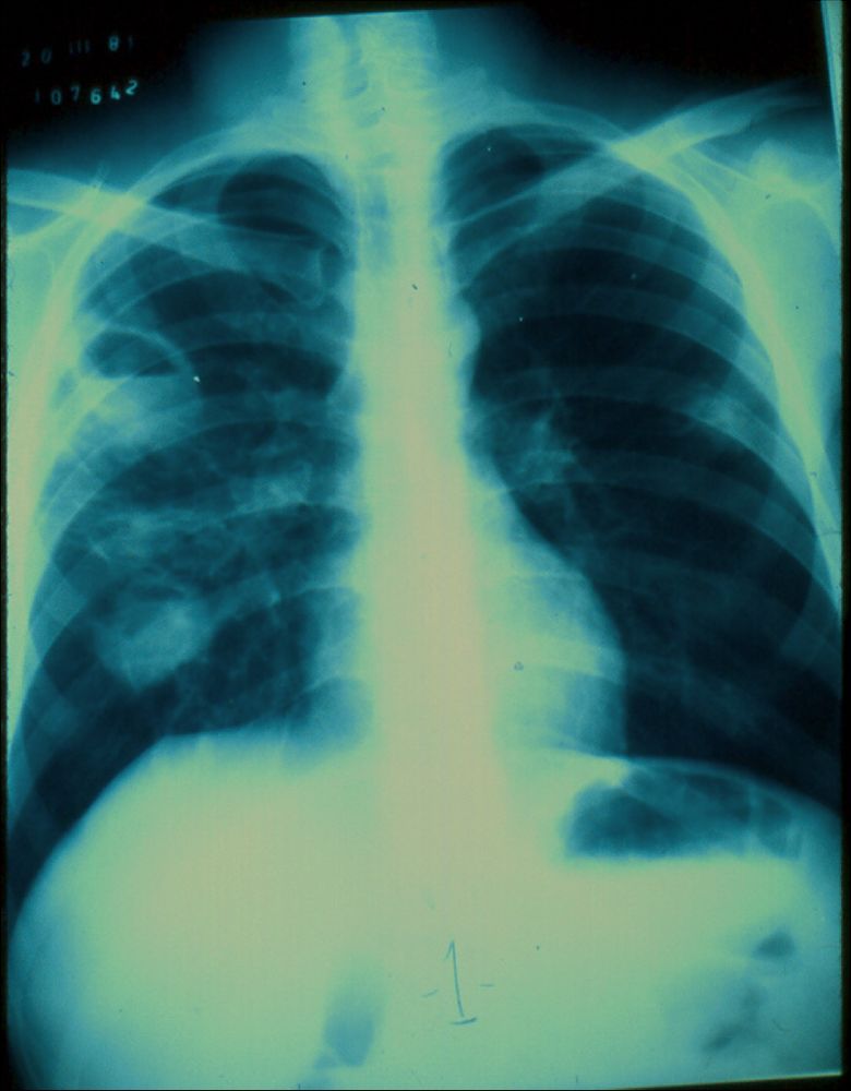 Síndromes de necrosis cutanea: un reto en la consulta del dermatólogo ...