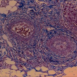 Síndromes de necrosis cutanea: un reto en la consulta del dermatólogo ...