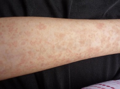 Caso Nº1 Ed.350: Lesiones pruriginosas que se iniciaron en tronco y se ...