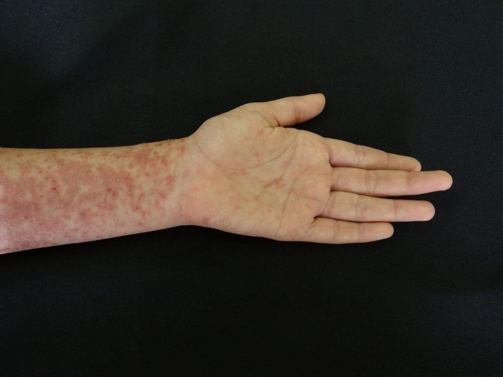 Caso Nº1 Ed.350: Lesiones pruriginosas que se iniciaron en tronco y se ...