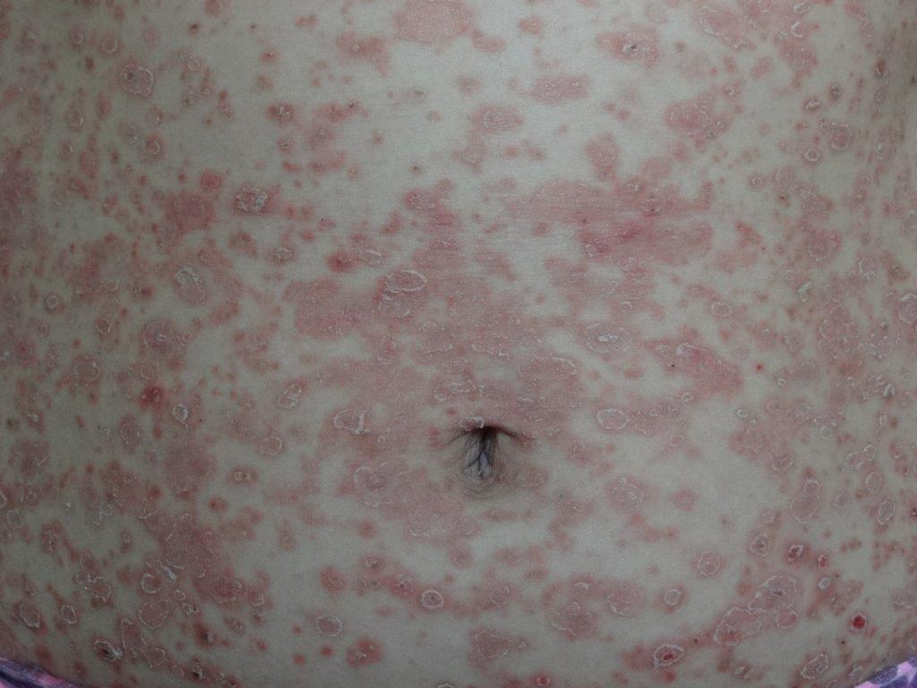 Caso Nº1 Ed.350: Lesiones pruriginosas que se iniciaron en tronco y se ...