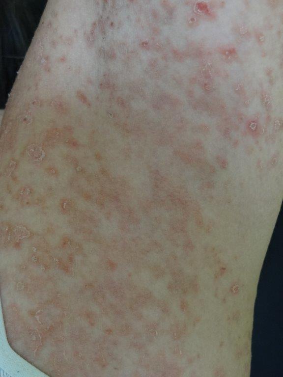 Caso Nº1 Ed.350: Lesiones pruriginosas que se iniciaron en tronco y se ...