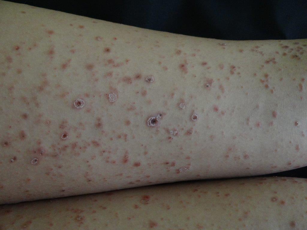 Caso Nº1 Ed.350: Lesiones pruriginosas que se iniciaron en tronco y se ...