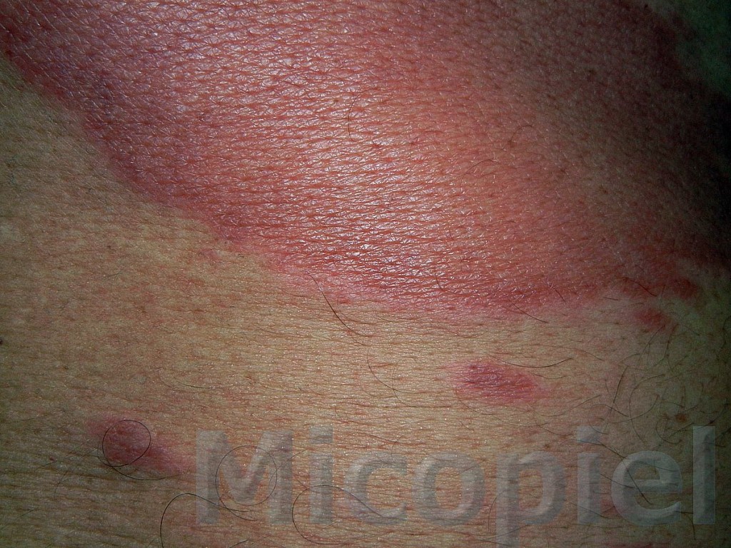 Caso clínico Nº 66. Dermatosis Generalizada – PIEL-L Latinoamericana