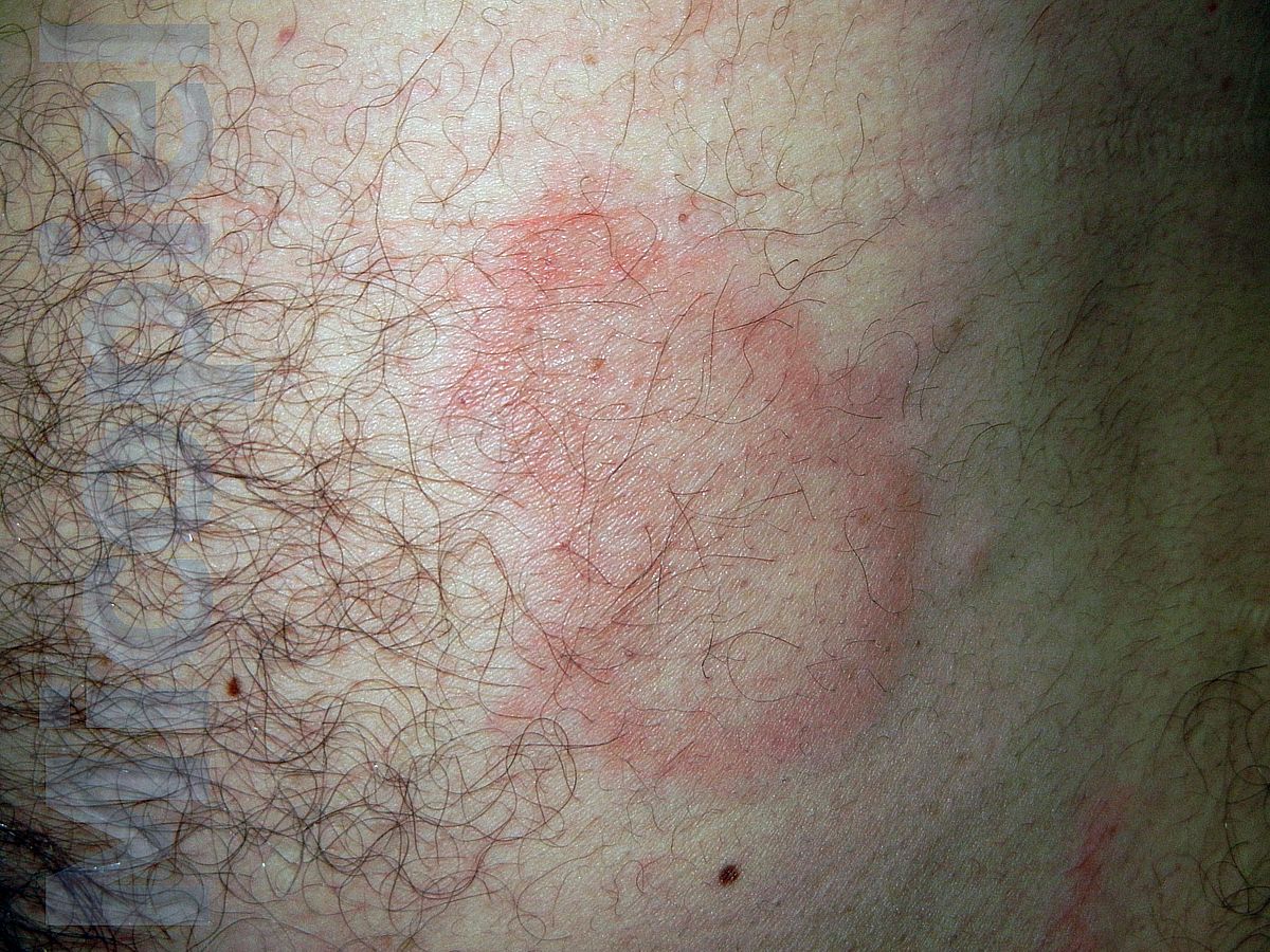 Caso clínico Nº 66. Dermatosis Generalizada – PIEL-L Latinoamericana