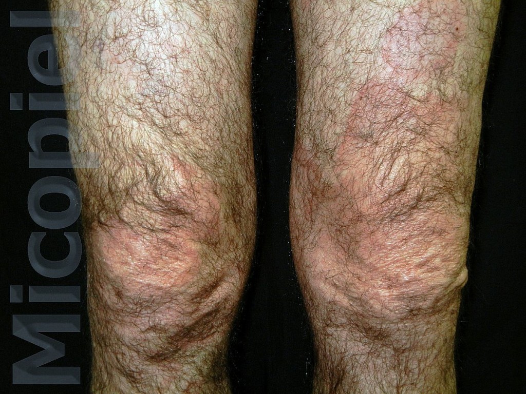 Caso clínico Nº 66. Dermatosis Generalizada – PIEL-L Latinoamericana