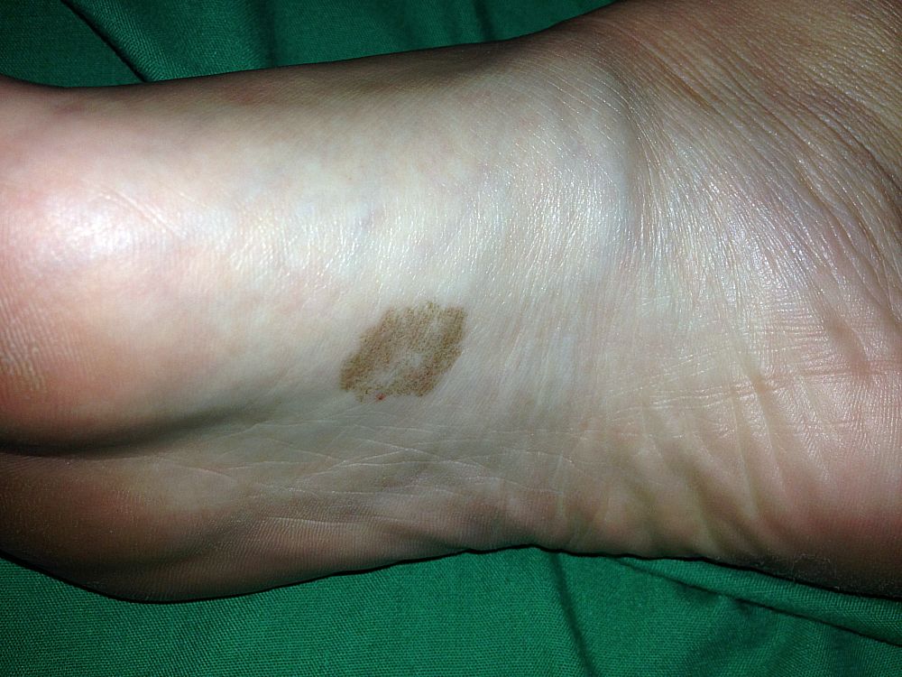 Caso Nº1 Ed.352: Tiña negra plantar tratada con dermoabrasión – PIEL-L ...