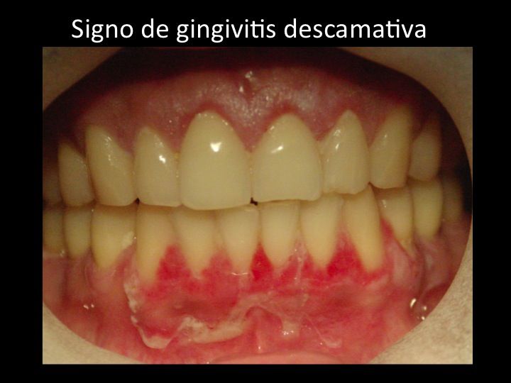 Lesiones gingivales descamativas dolorosas – PIEL-L Latinoamericana