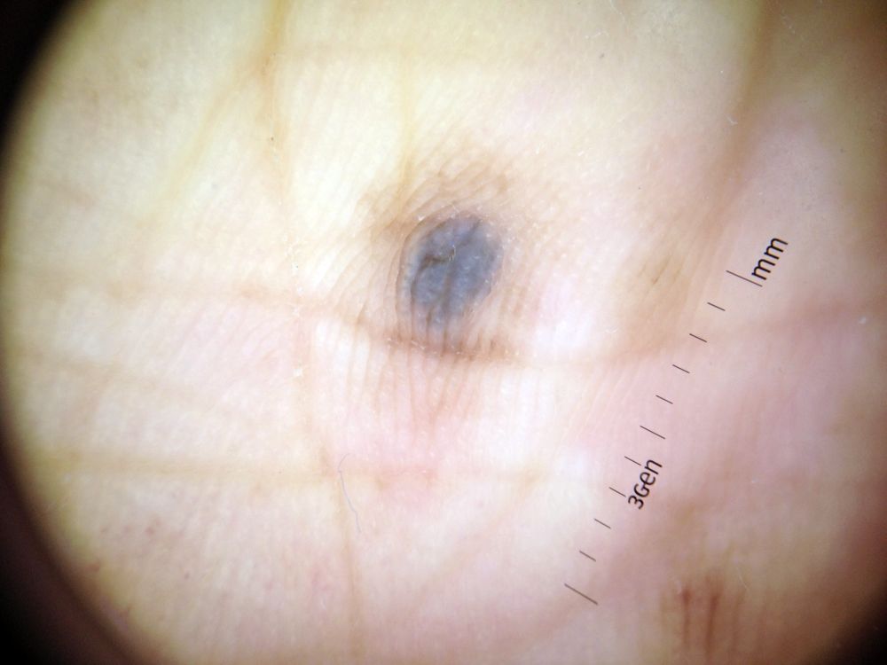 Dermatoscopia Ed.354 – PIEL-L Latinoamericana