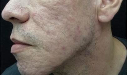 Severas secuelas de Acné conglobata – PIEL-L Latinoamericana