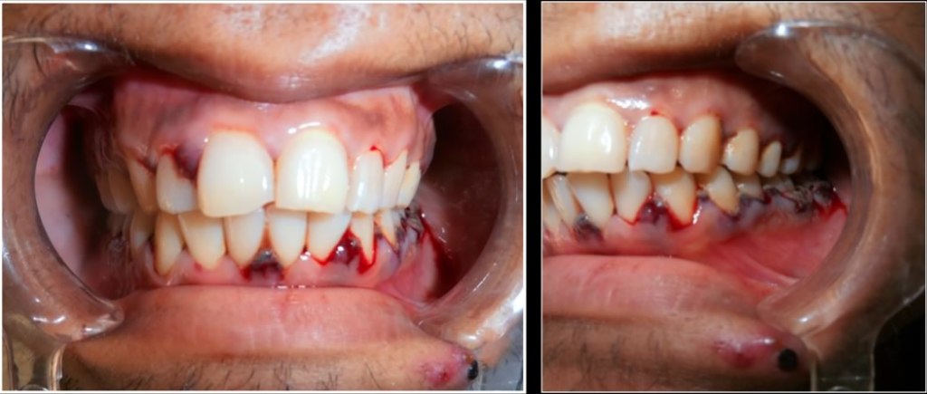 Leucemia mieloide aguda: manifestación bucal asociada – PIEL-L ...