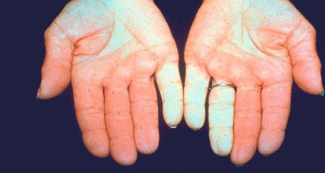 Acrosindromes – PIEL-L Latinoamericana