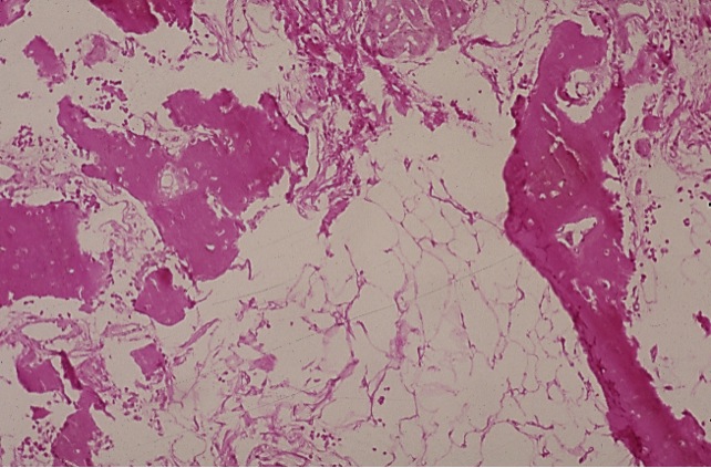 Heteroplasia ósea progresiva – PIEL-L Latinoamericana
