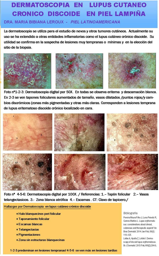 Dermatoscopia en lupus discoideo crónico – PIEL-L Latinoamericana