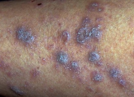 Resultados de búsqueda para “liquen” – PIEL-L Latinoamericana