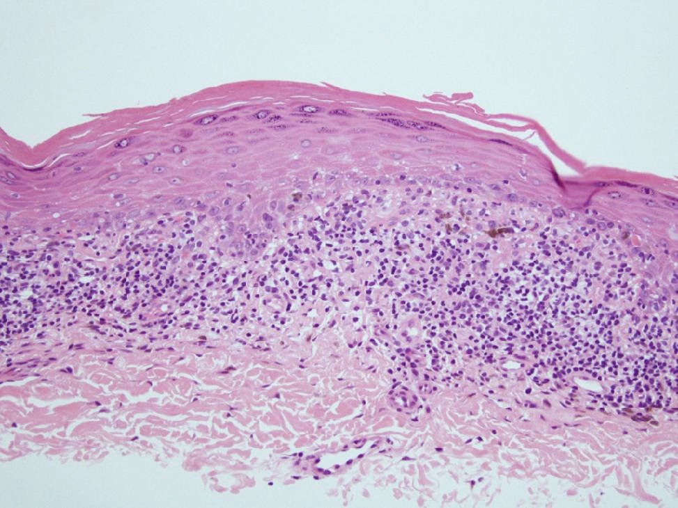 Caso Nº3 Ed.379: Liquen plano? Lupus cutaneo?, Mastocitoma ...