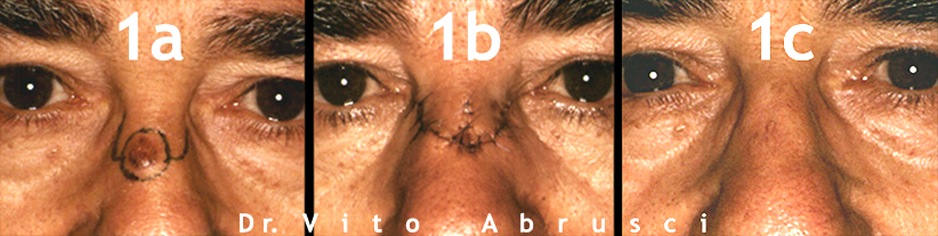 Carcinoma basocelular del dorso nasal Tratado con MODIFIED PINCH FLAP ...
