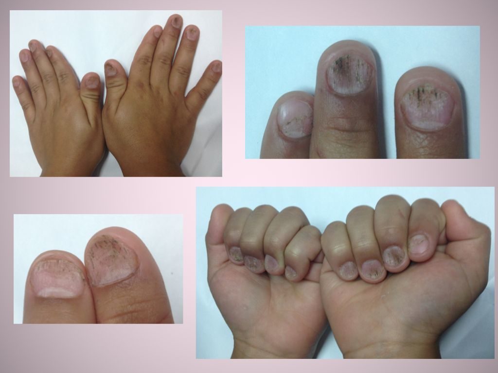 Caso clinico de Pasoriasis en niño con afectación ungueal – PIEL-L ...