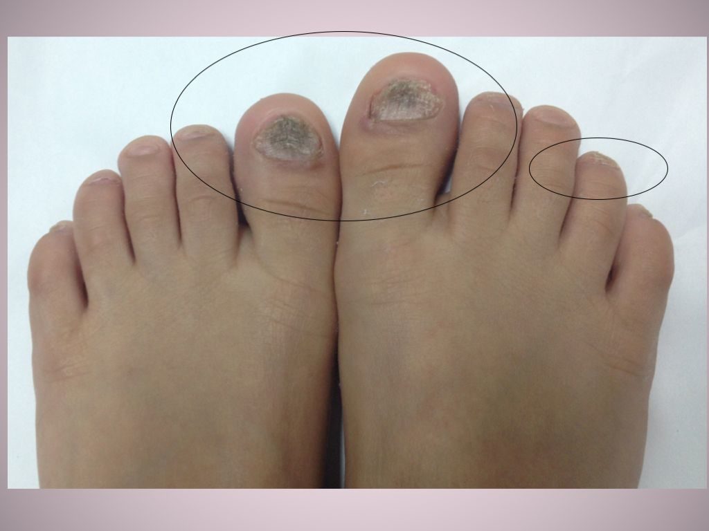 Caso clinico de Pasoriasis en niño con afectación ungueal – PIEL-L ...