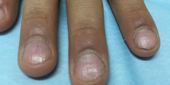 Psoriasis en Niño. Caso clínico con afectación ungueal. – PIEL-L ...