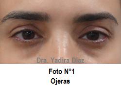 Manejos de las ojeras ¿Admirarlas o tratarlas? – PIEL-L Latinoamericana