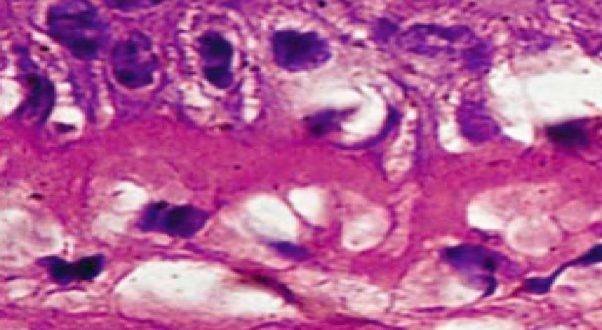 Membrana basal engrosada – PIEL-L Latinoamericana