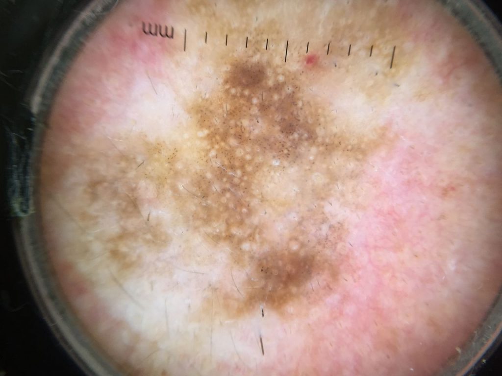 Dermatoscopia Ed. 414 – PIEL-L Latinoamericana