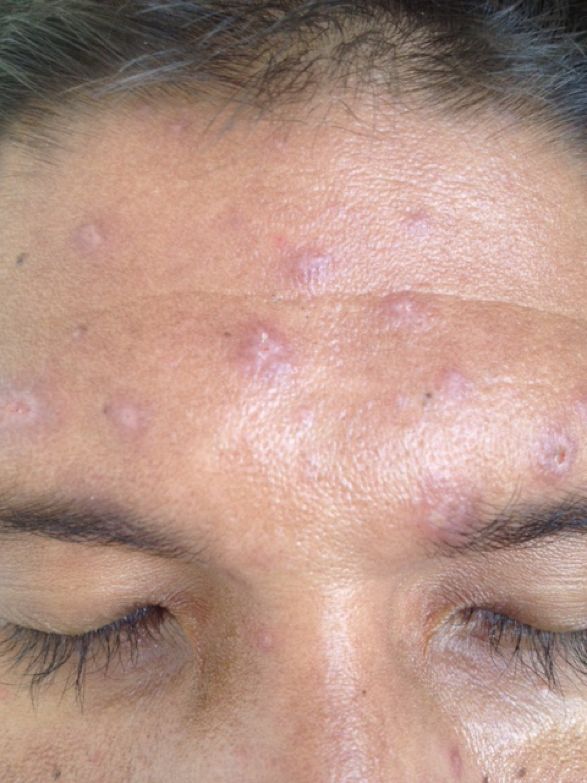 Erupción acneiforme – PIEL-L Latinoamericana