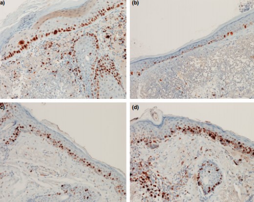 Incremento del número de mastocitos en dermis de lesiones de queratosis ...