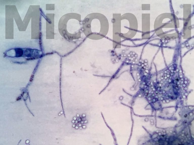 Tiña del Cuerpo Inflamatoria Ampollar – PIEL-L Latinoamericana
