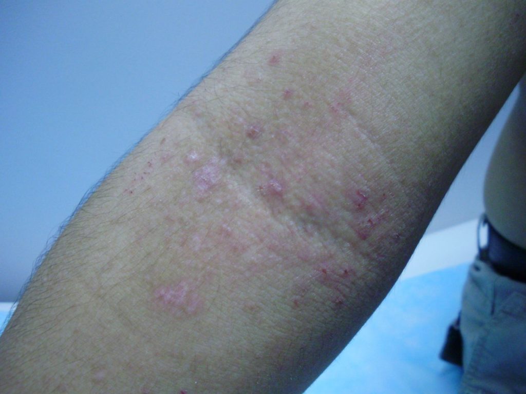 Dermatitis Atópica y Filagrina – PIEL-L Latinoamericana