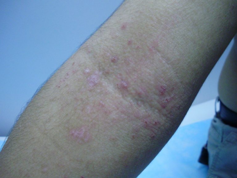 Dermatitis Atópica y Filagrina – PIEL-L Latinoamericana