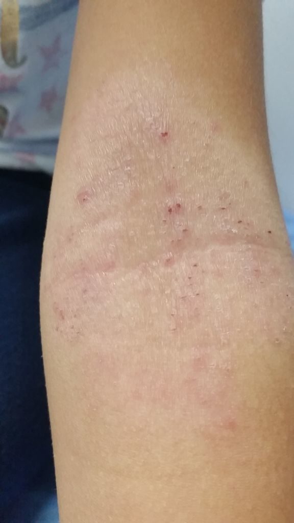 Dermatitis Atópica y Filagrina – PIEL-L Latinoamericana