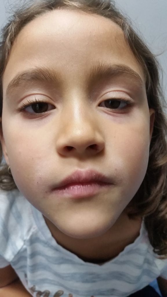 Dermatitis Atópica y Filagrina – PIEL-L Latinoamericana