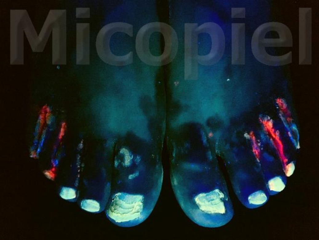 Caso clínico Nº 77. Dermatofitosis, Eritrasma y SIDA Solapadas – PIEL-L ...