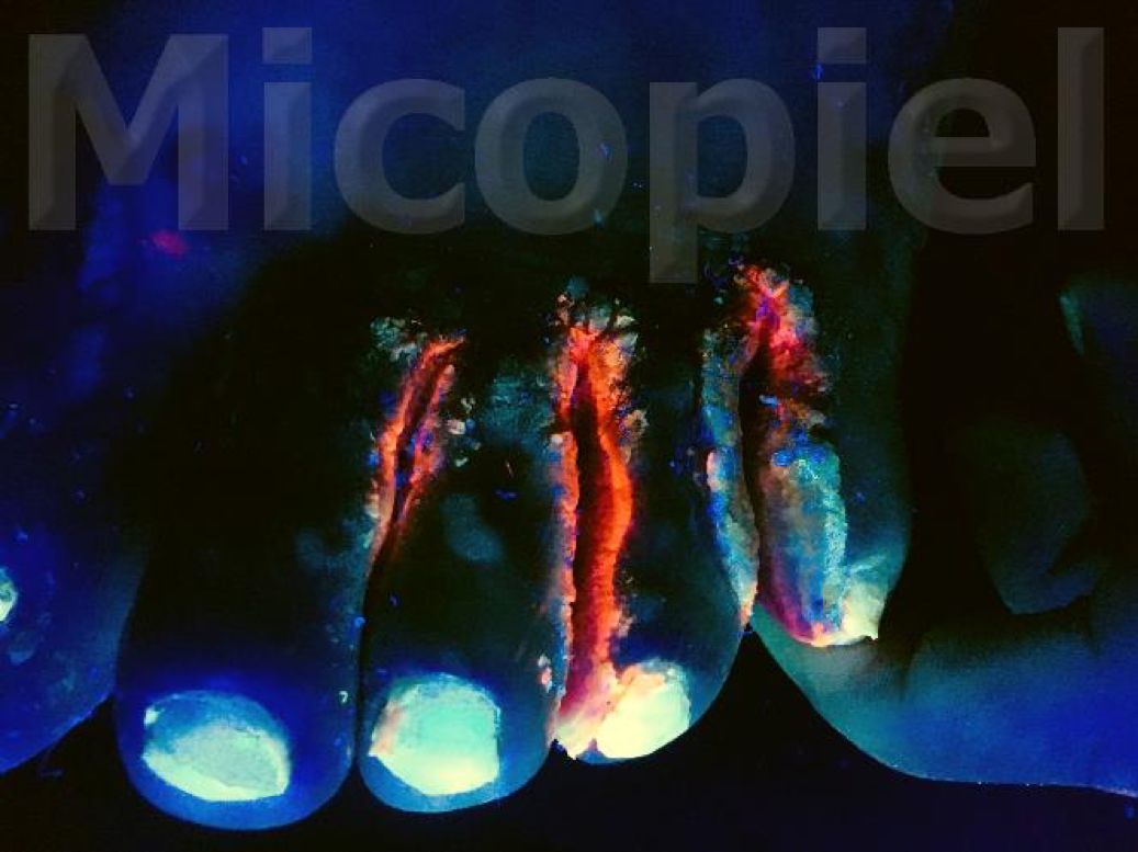 Caso clínico Nº 77. Dermatofitosis, Eritrasma y SIDA Solapadas – PIEL-L ...