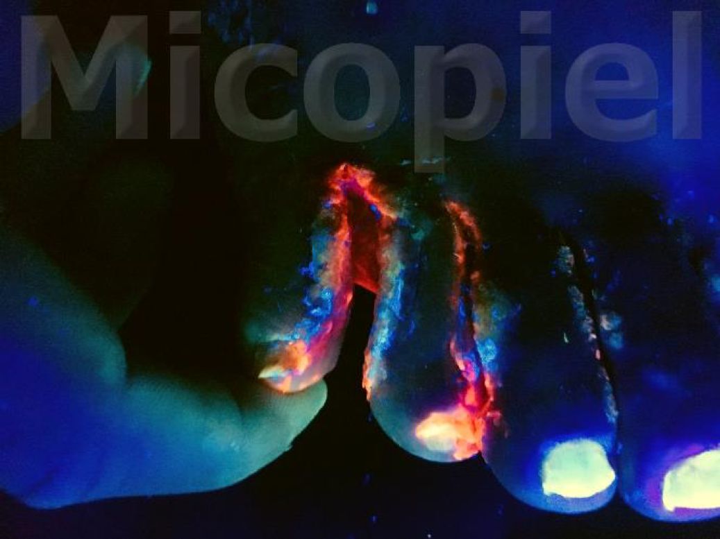 Caso clínico Nº 77. Dermatofitosis, Eritrasma y SIDA Solapadas – PIEL-L ...