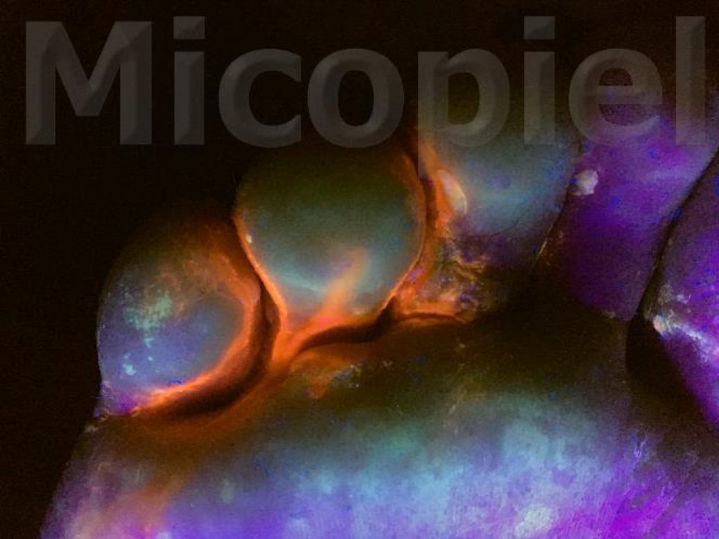 Caso clínico Nº 77. Dermatofitosis, Eritrasma y SIDA Solapadas – PIEL-L ...