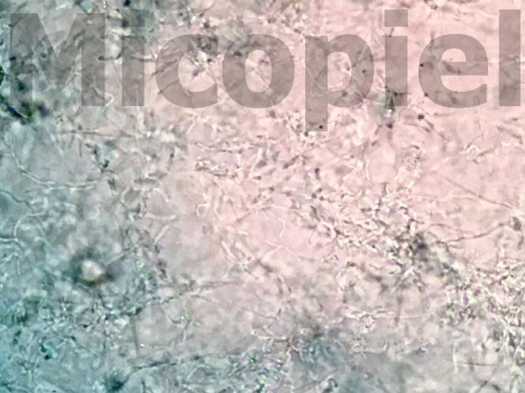 Caso clínico Nº 77. Dermatofitosis, Eritrasma y SIDA Solapadas – PIEL-L ...