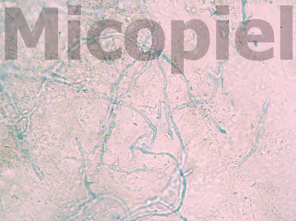 Caso clínico Nº 77. Dermatofitosis, Eritrasma y SIDA Solapadas – PIEL-L ...