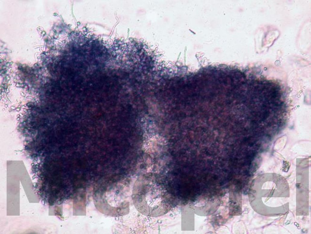 Caso clínico Nº 77. Dermatofitosis, Eritrasma y SIDA Solapadas – PIEL-L ...