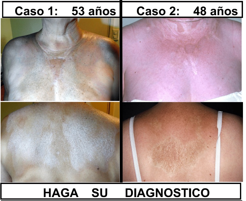 Placas esclerodermiformes en cuello y tronco. Diagnóstico diferencial ...