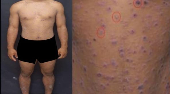 Pitiriasis Liquenoide y Varioliforme Aguda – PIEL-L Latinoamericana