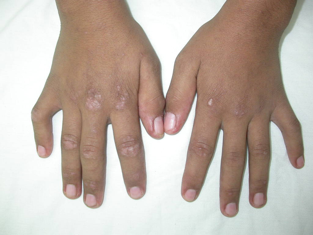 DERMATOMIOSITIS – PIEL-L Latinoamericana