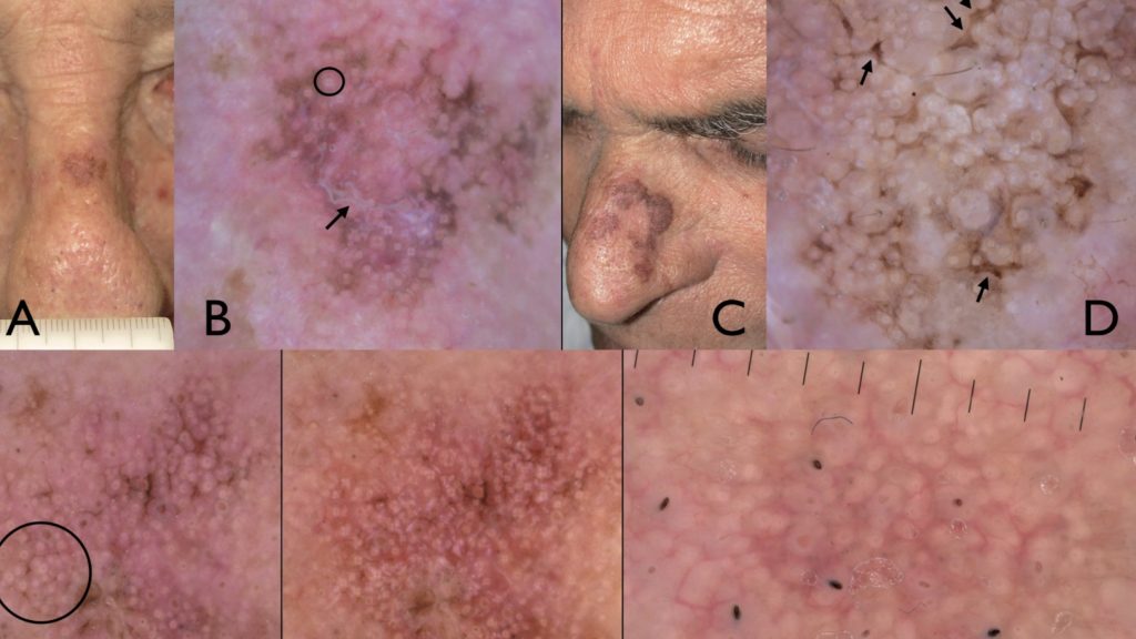 Queratosis solar – PIEL-L Latinoamericana