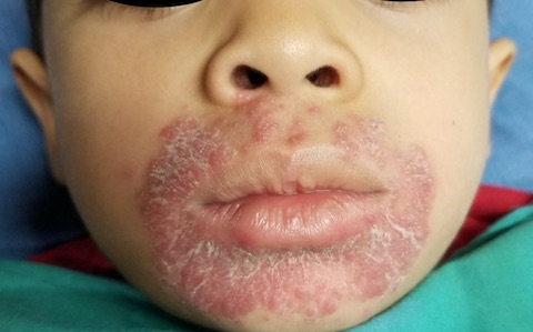 Dermatitis perioral de la infancia – PIEL-L Latinoamericana