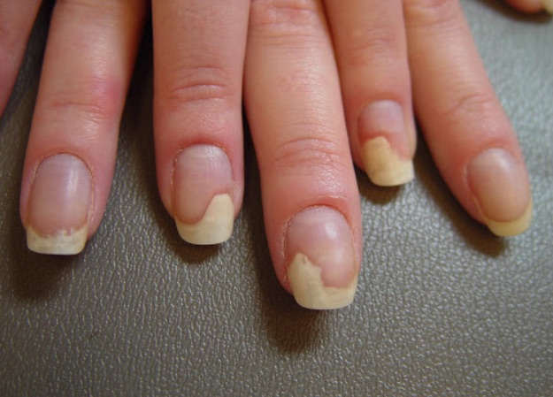 Onicolisis – Onycholysis – PIEL-L Latinoamericana