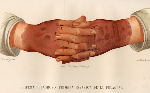 Eritema pelagroso (Primera invasión de la pelagra) – PIEL-L Latinoamericana