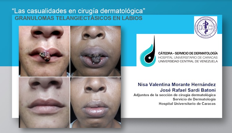 «Las casualidades en cirugía dermatológica». GRANULOMAS ...